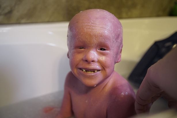 Little Boy With Rare Skin Condition Shows Life is Always Worth Living ...